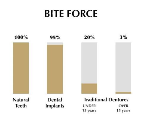 Benefits of Dental Implants - Brushwell Dental & Implants