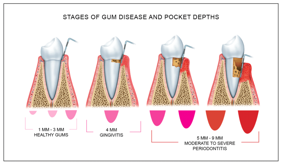 How Gums are Measured - Brushwell Dental & Implants